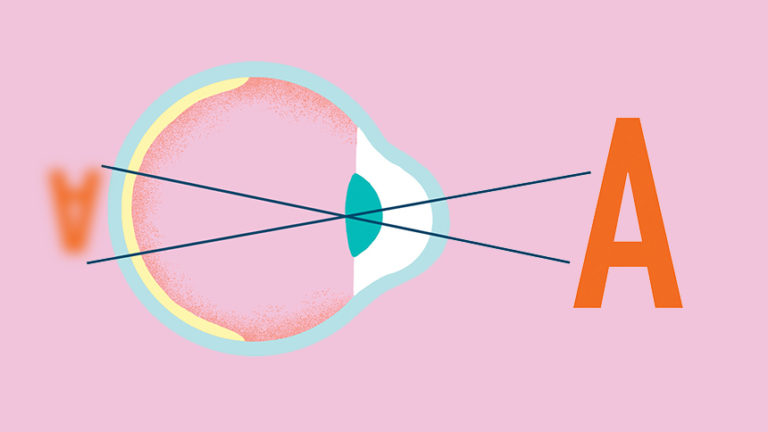 La presbytie c'est quoi ? Comment la corriger ? - Entrevoir