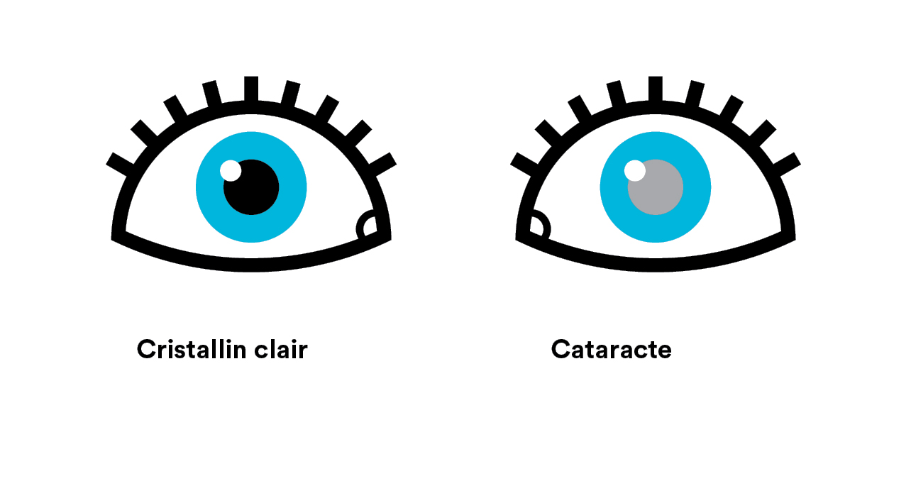 Le cristallin - Bienvu!, le magazine de la santé visuelle