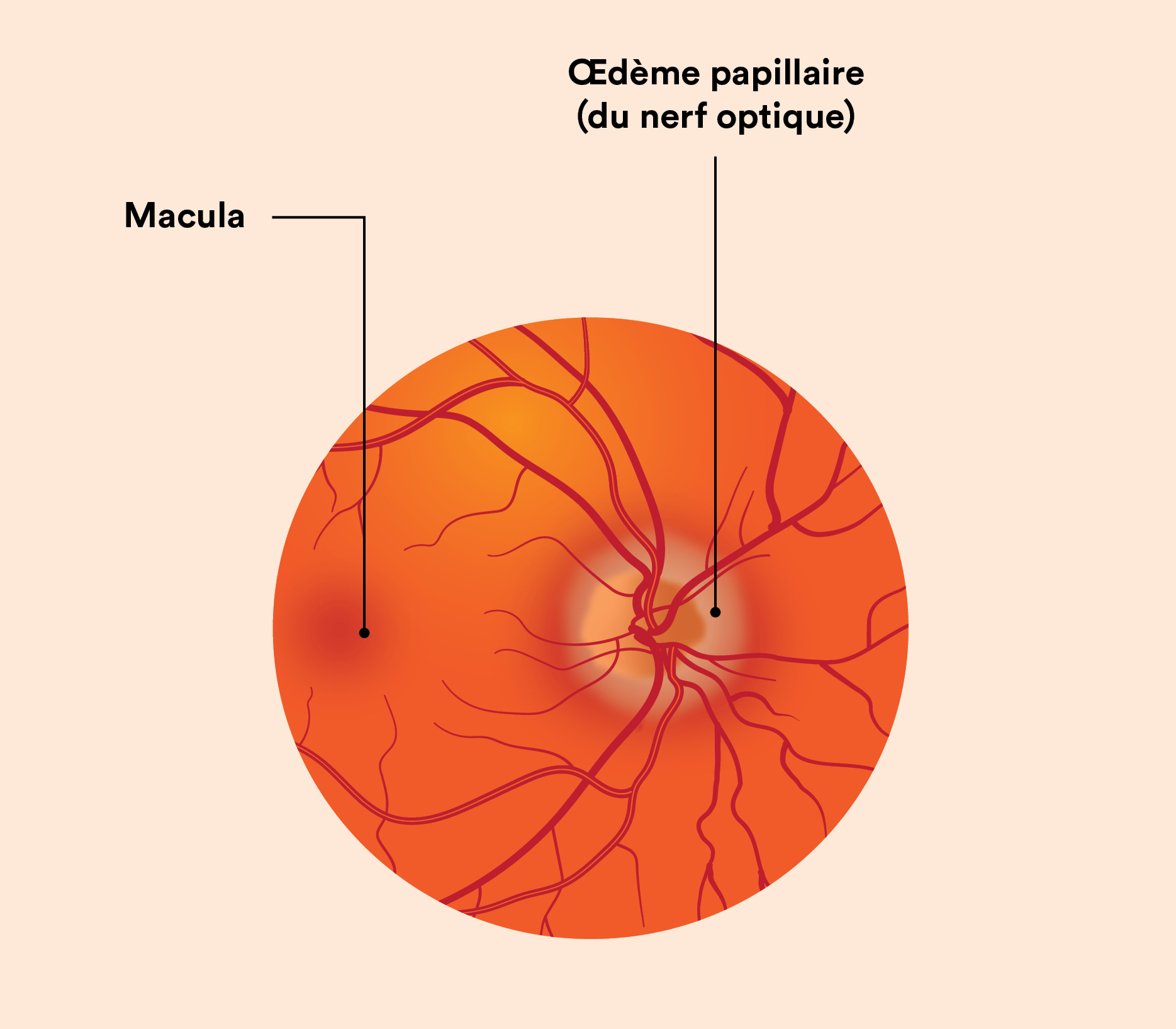 Névrite du nerf optique - Bienvu!, le magazine de la santé visuelle